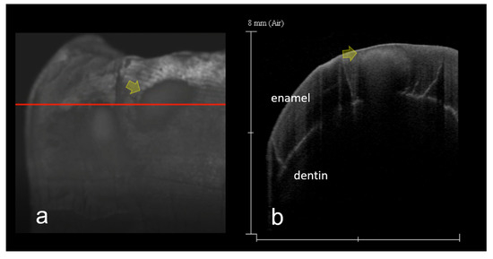 Evaluation of Incipient Enamel Caries at Smooth Tooth Surfaces Using SS-OCT