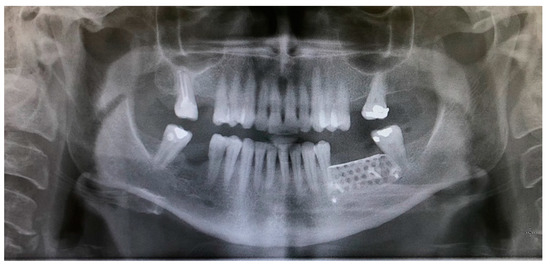 Customized Titanium Mesh for Guided Bone Regeneration with Autologous ...