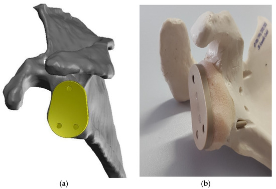 Temporary Protective Shoulder Implants for Revision Surgery with Bone ...