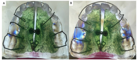 Photoelasticity for Stress Concentration Analysis in Dentistry and Medicine