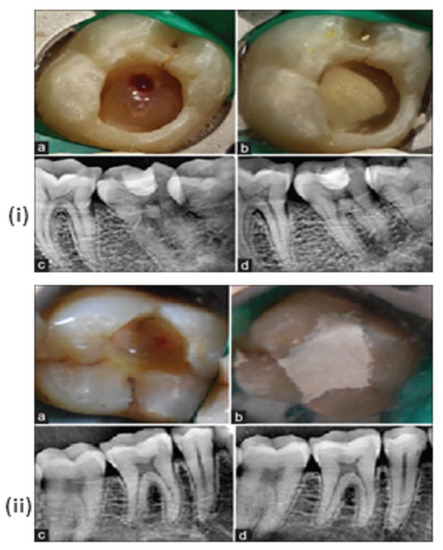 Bioactive Inorganic Materials for Dental Applications: A Narrative Review