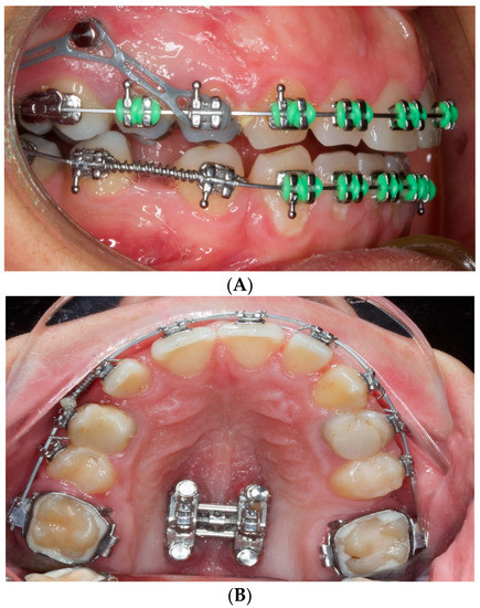 Bacteriostatic Poly Ethylene Glycol Plasma Coatings for Orthodontic ...