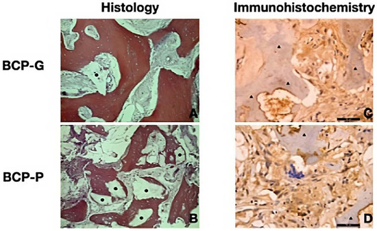 Clinical Assessment of Biphasic Calcium Phosphate in Granules and Paste ...