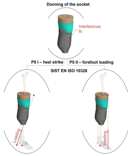 Materials | Free Full-Text | Numerical Analysis of a Transtibial ...