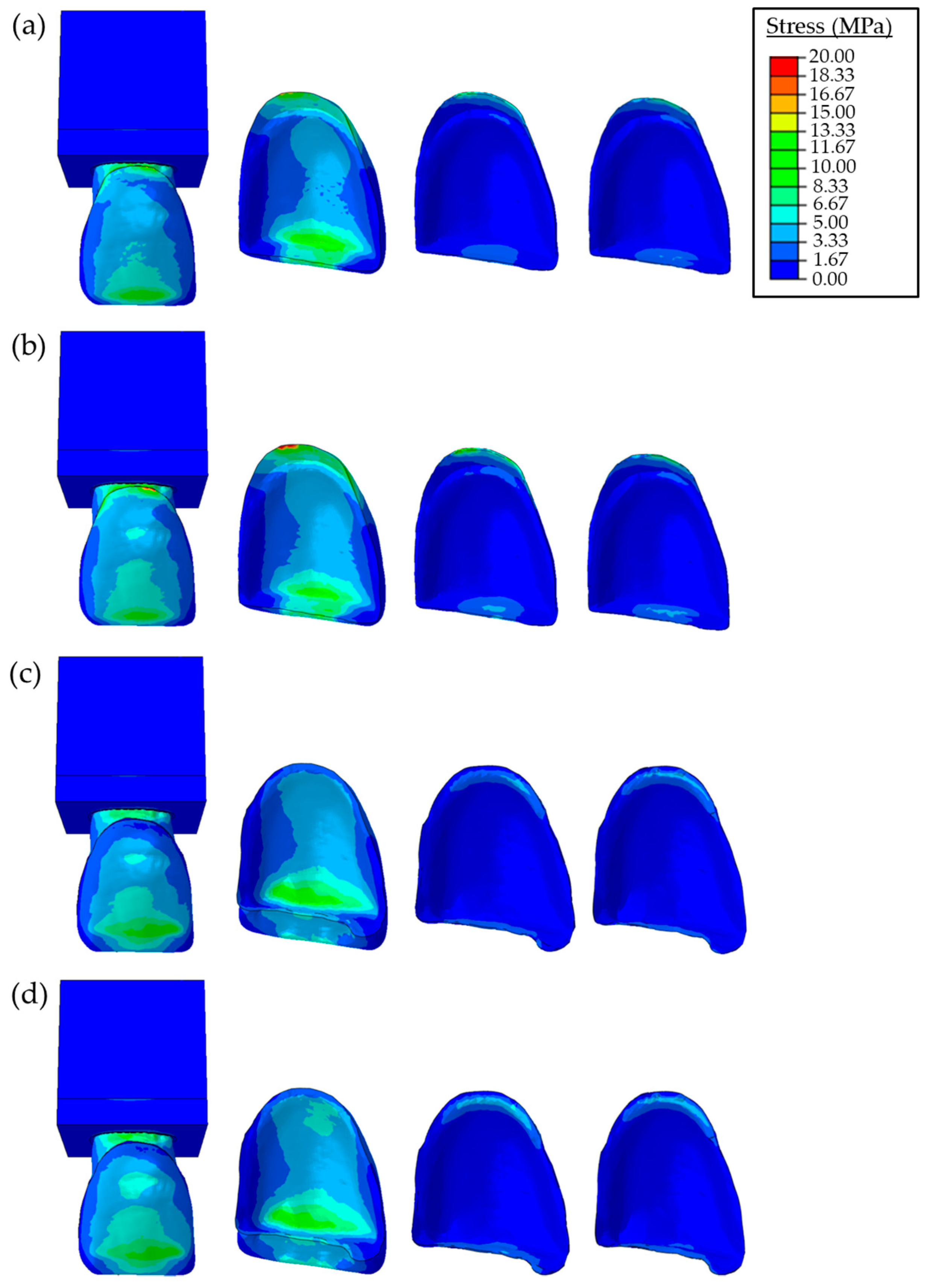 Biomechanical Behavior Evaluation of Resin Cement with Different ...