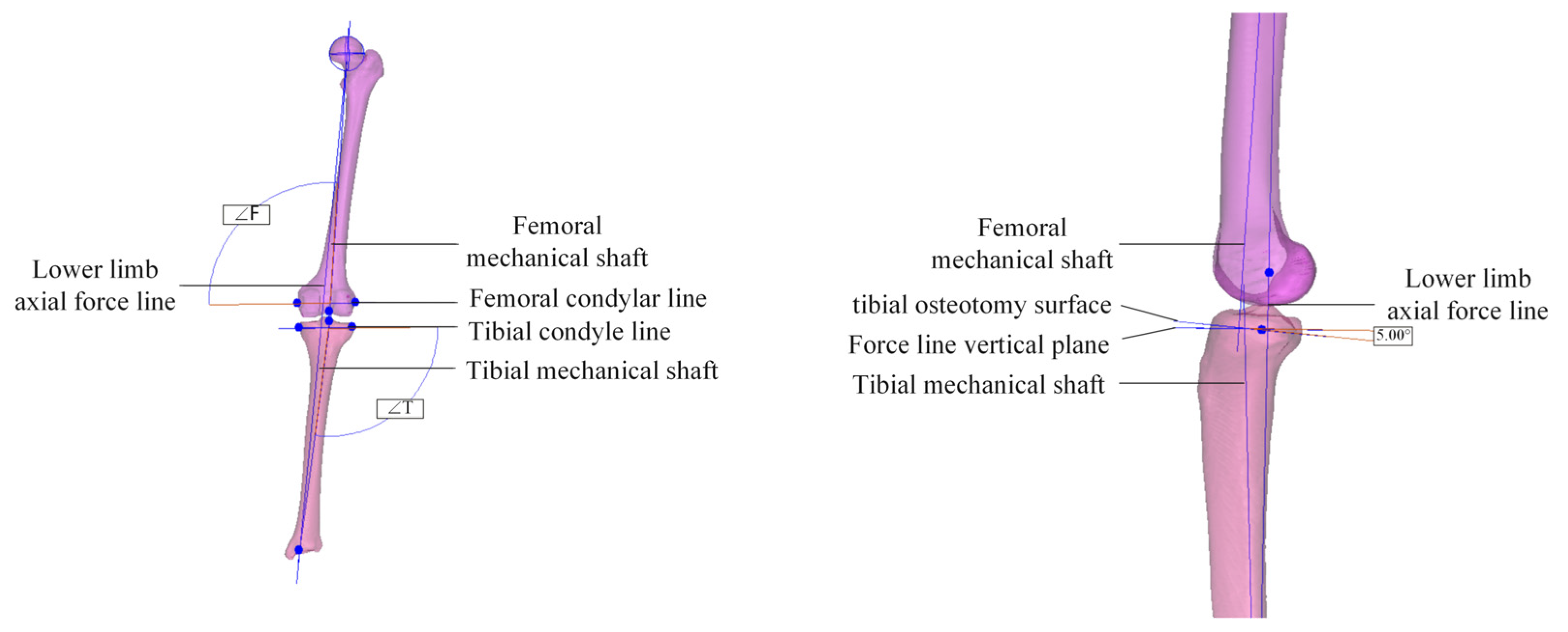 Design and Manufacturing of a Novel Trabecular Tibial Implant