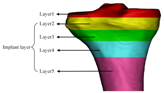 Design and Manufacturing of a Novel Trabecular Tibial Implant