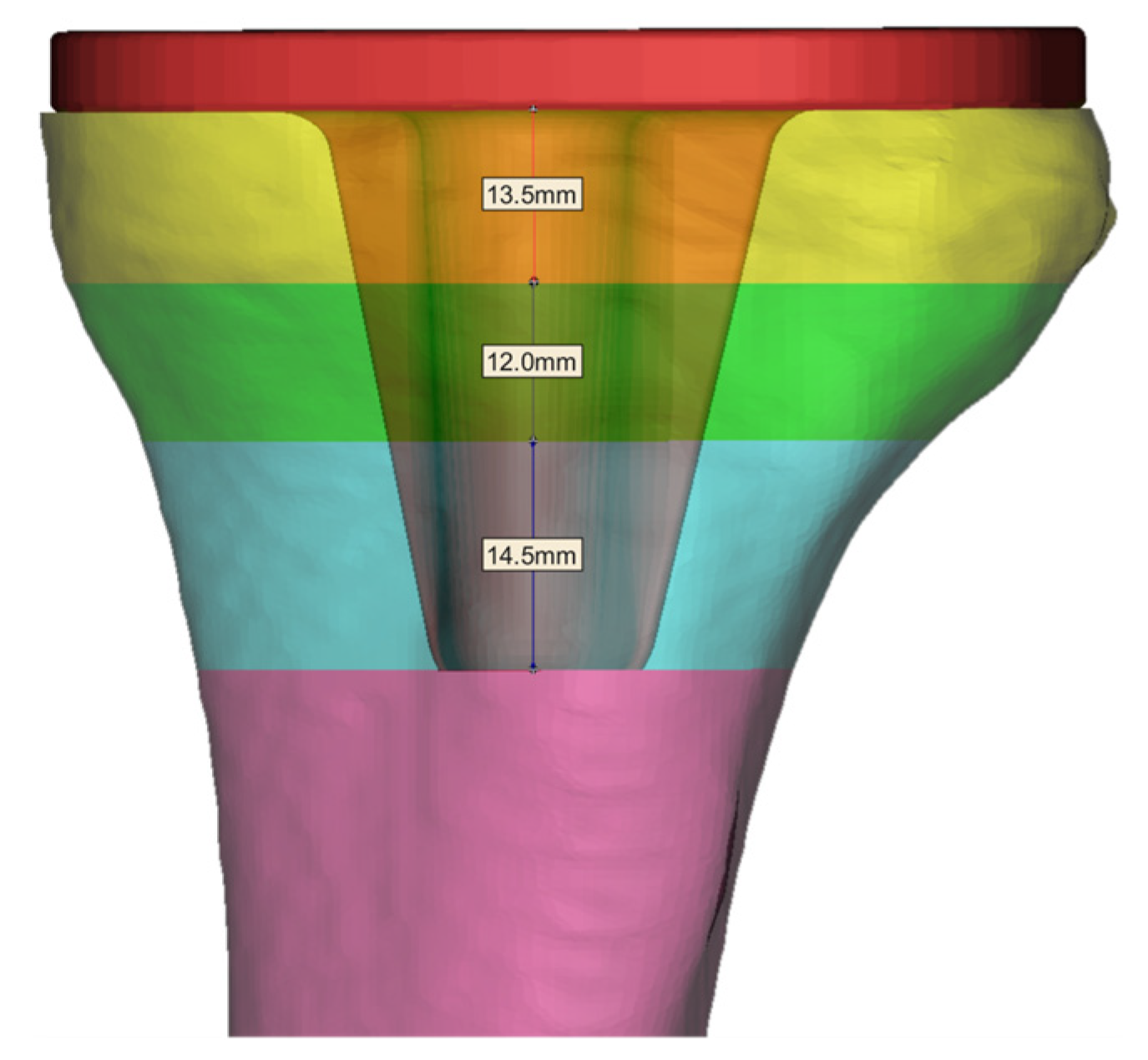 Design and Manufacturing of a Novel Trabecular Tibial Implant