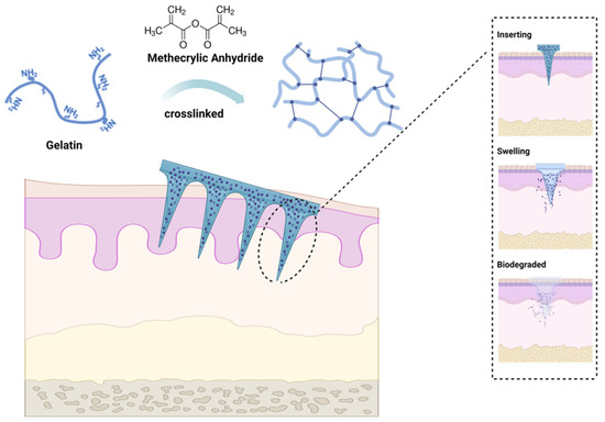 Hydrogel-Forming Microneedles with Applications in Oral Diseases Management