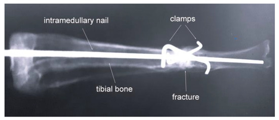 NiTi Shape Memory Clamps with Modified Surface for Bone Fracture Treatment