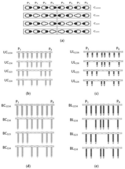 Stability Analysis of Plate—Screw Fixation for Femoral Midshaft Fractures