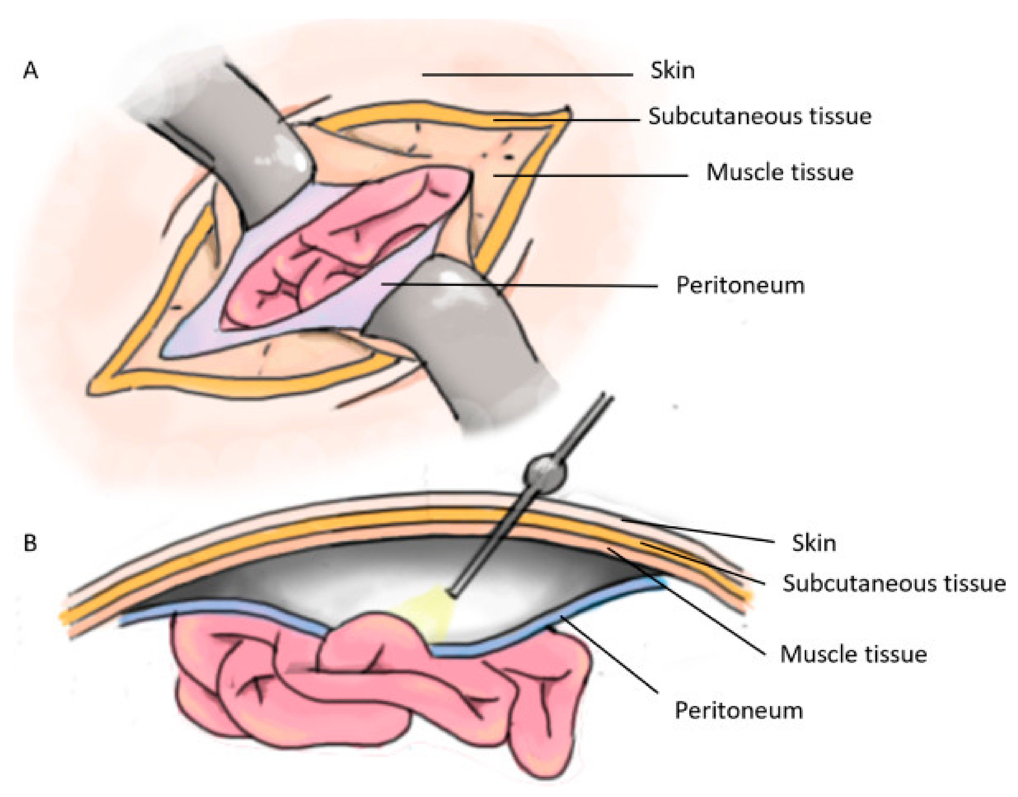 A Review of Abdominal Meshes for Hernia Repair—Current Status and Emerging Solutions