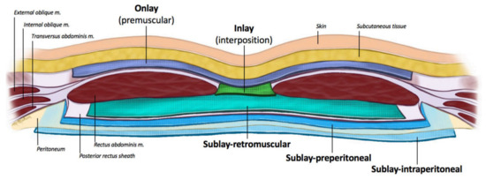 A Review of Abdominal Meshes for Hernia Repair—Current Status and ...