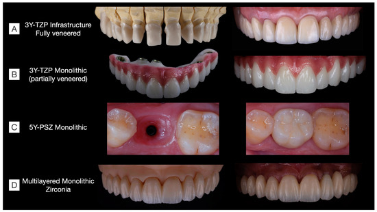 A Narrative Review on Polycrystalline Ceramics for Dental Applications ...