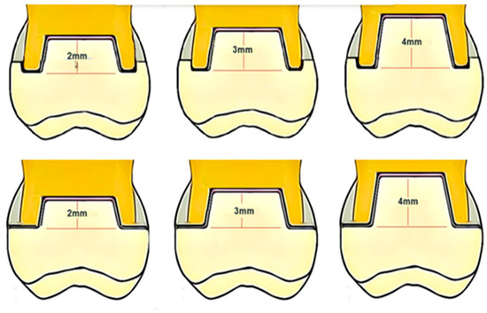 The Influence of Ferrule Design and Pulpal Extensions on the Accuracy ...