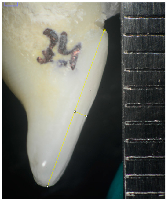 In Vitro Study on the Influence of the Buccal Surface Convexity of the ...