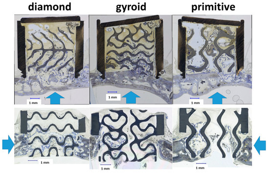 TPMS Microarchitectures for Vertical Bone Augmentation and ...