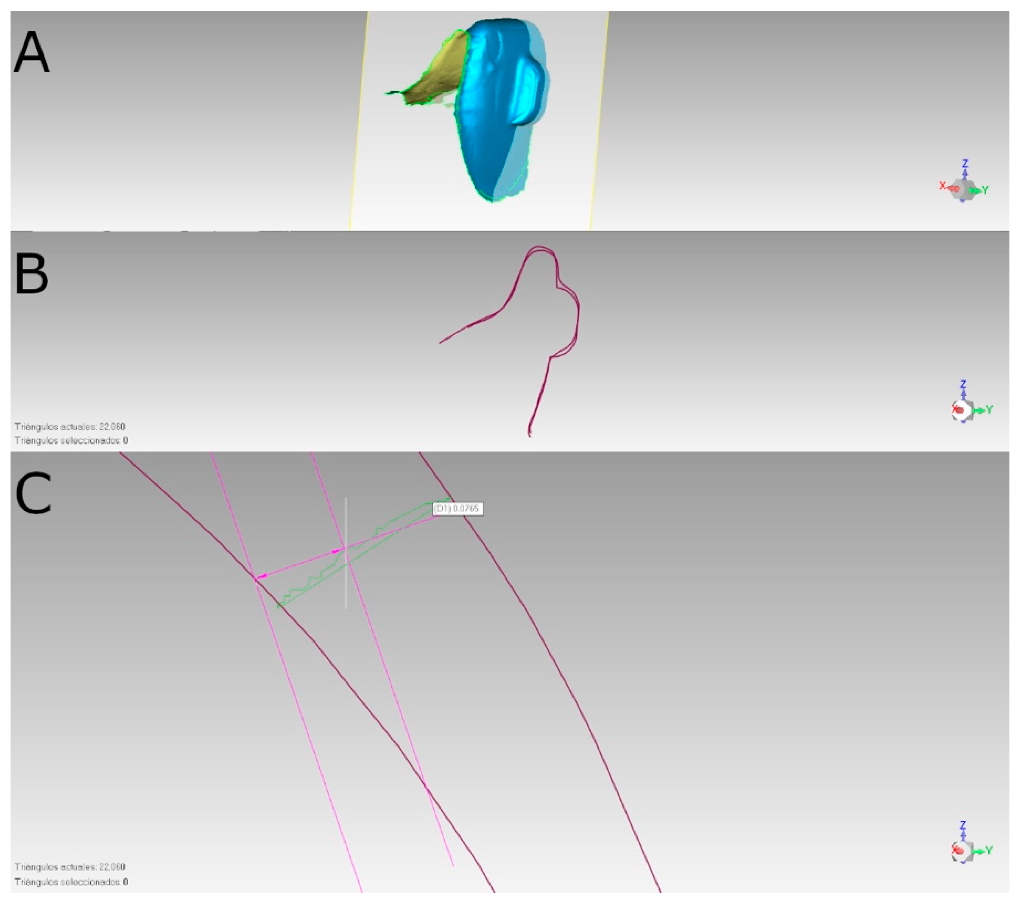 Accuracy Evaluation of Indirect Bonding Techniques for Clear Aligner Attachments Using 3D ...
