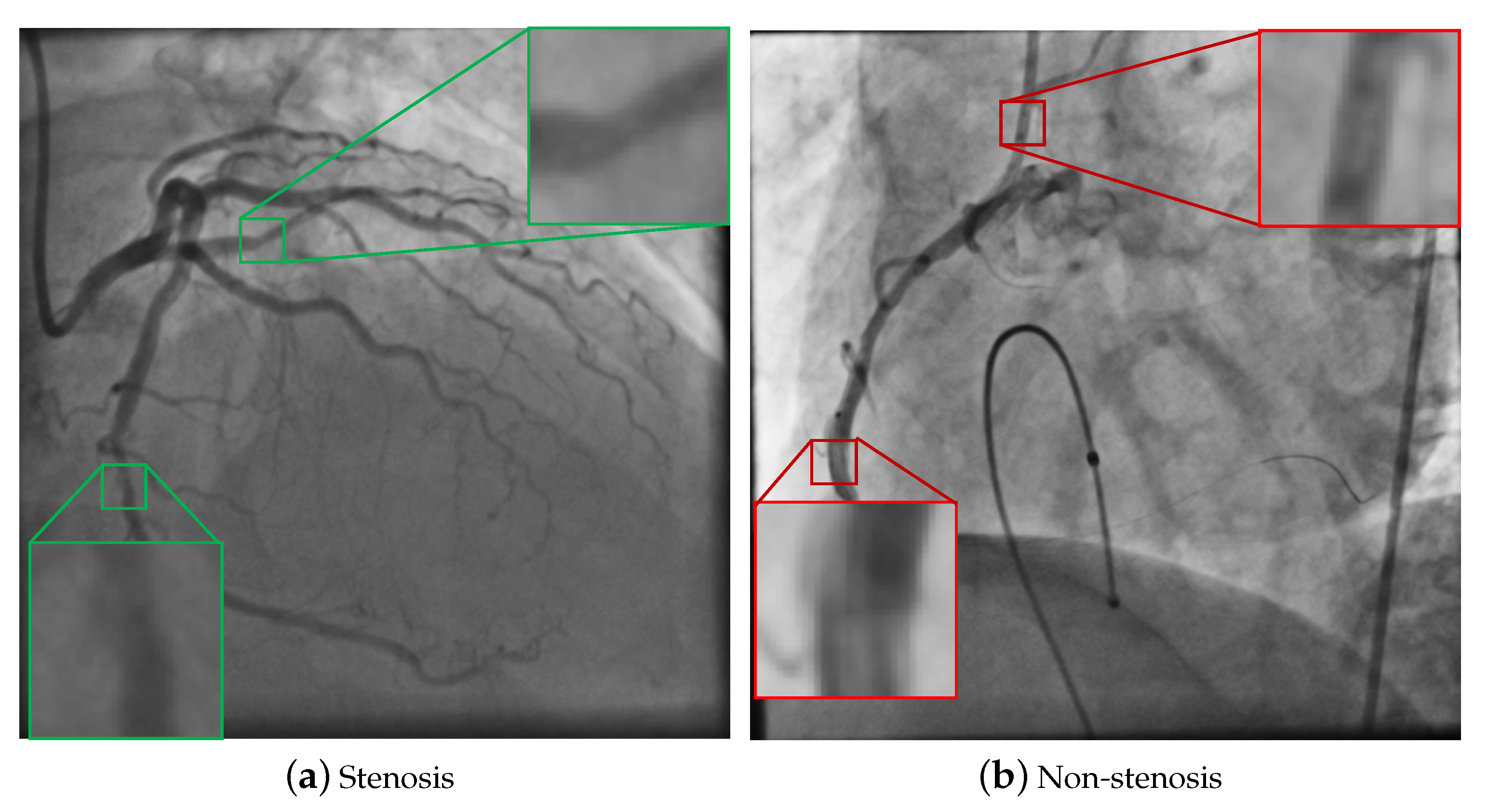 Transfer Learning for Stenosis Detection in X-ray Coronary Angiography