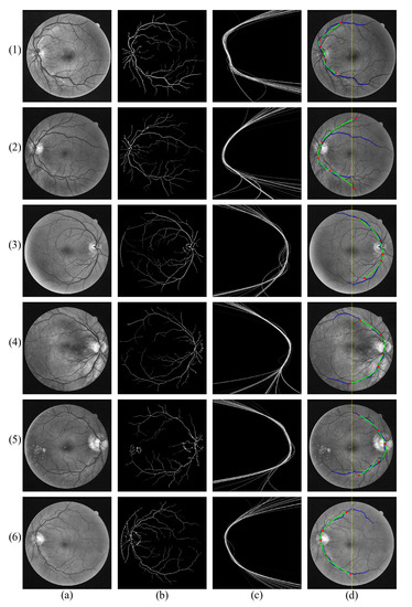 Robust Detection and Modeling of the Major Temporal Arcade in Retinal ...