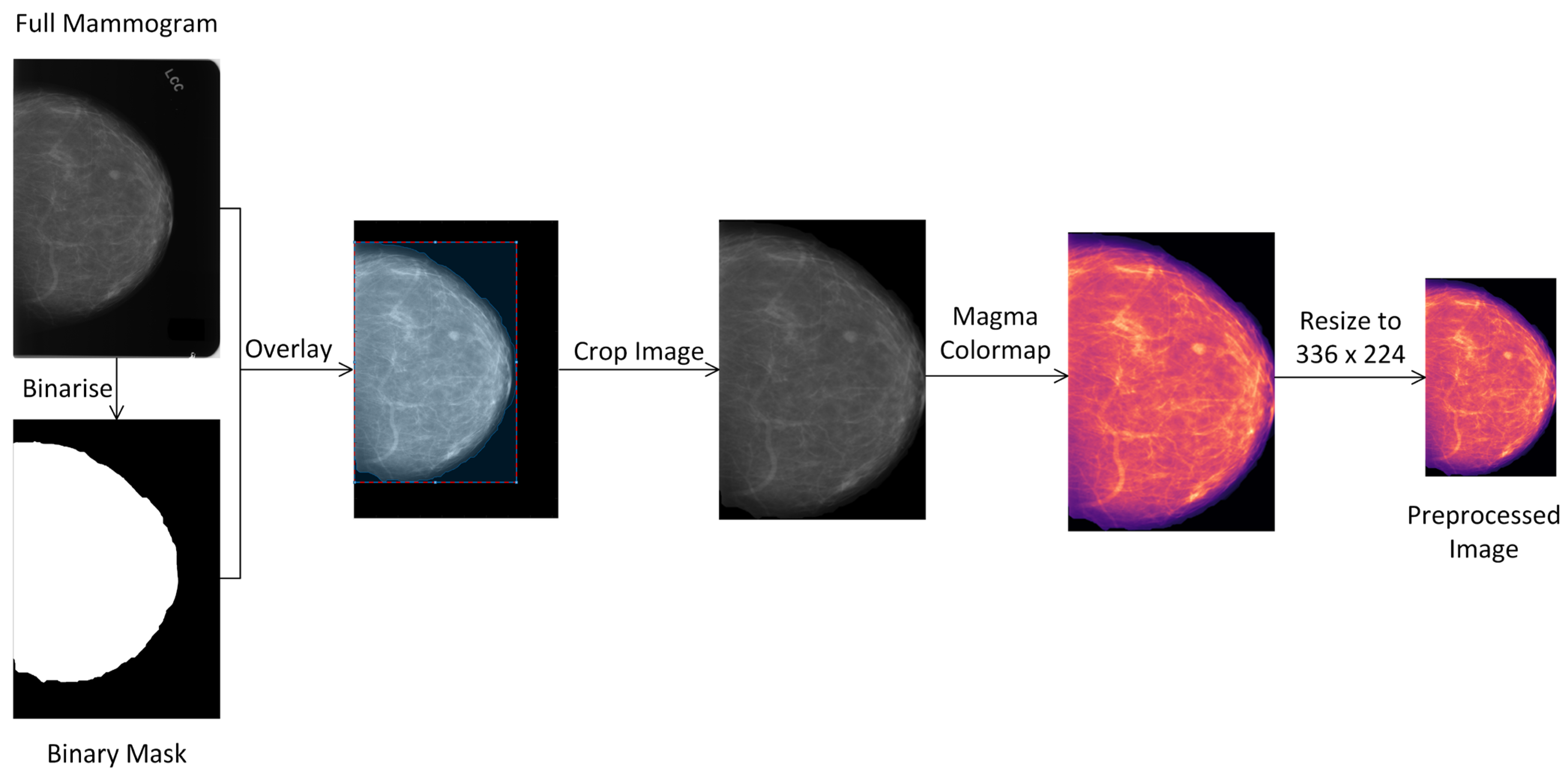 TwoViewDensityNet: Two-View Mammographic Breast Density Classification Based on Deep ...