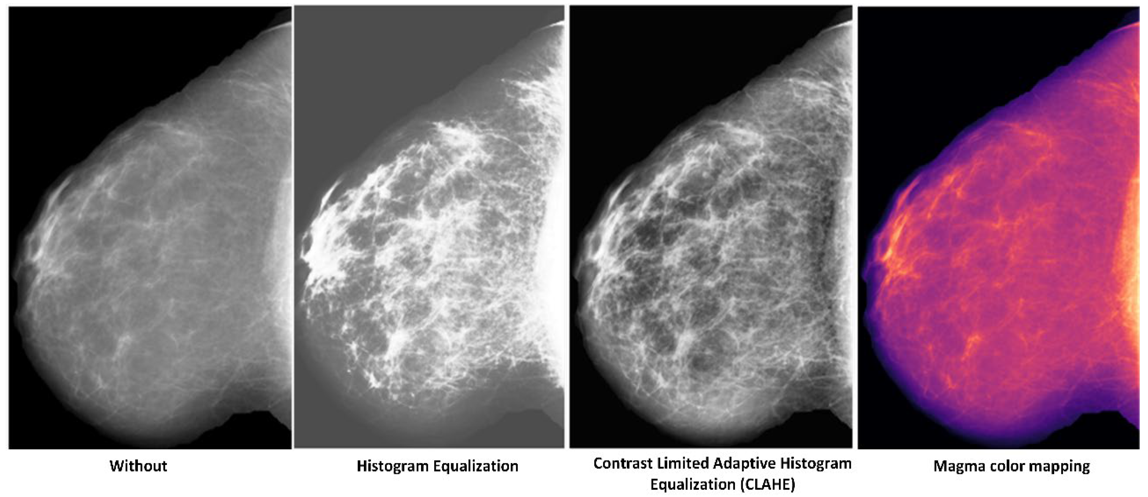 TwoViewDensityNet: Two-View Mammographic Breast Density Classification Based on Deep ...