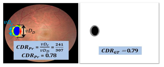 Assisting Glaucoma Screening Process Using Feature Excitation and ...