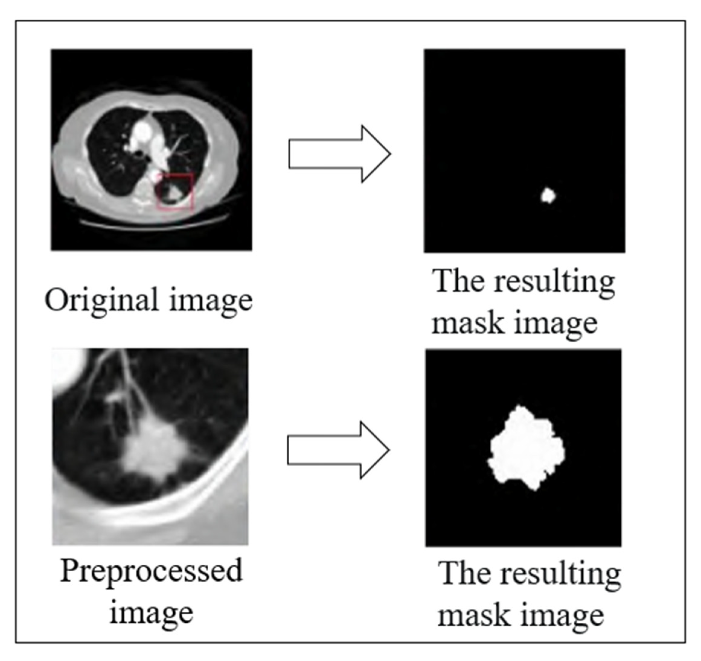 Lung Nodule CT Image Segmentation Model Based on Multiscale Dense Residual Neural Network