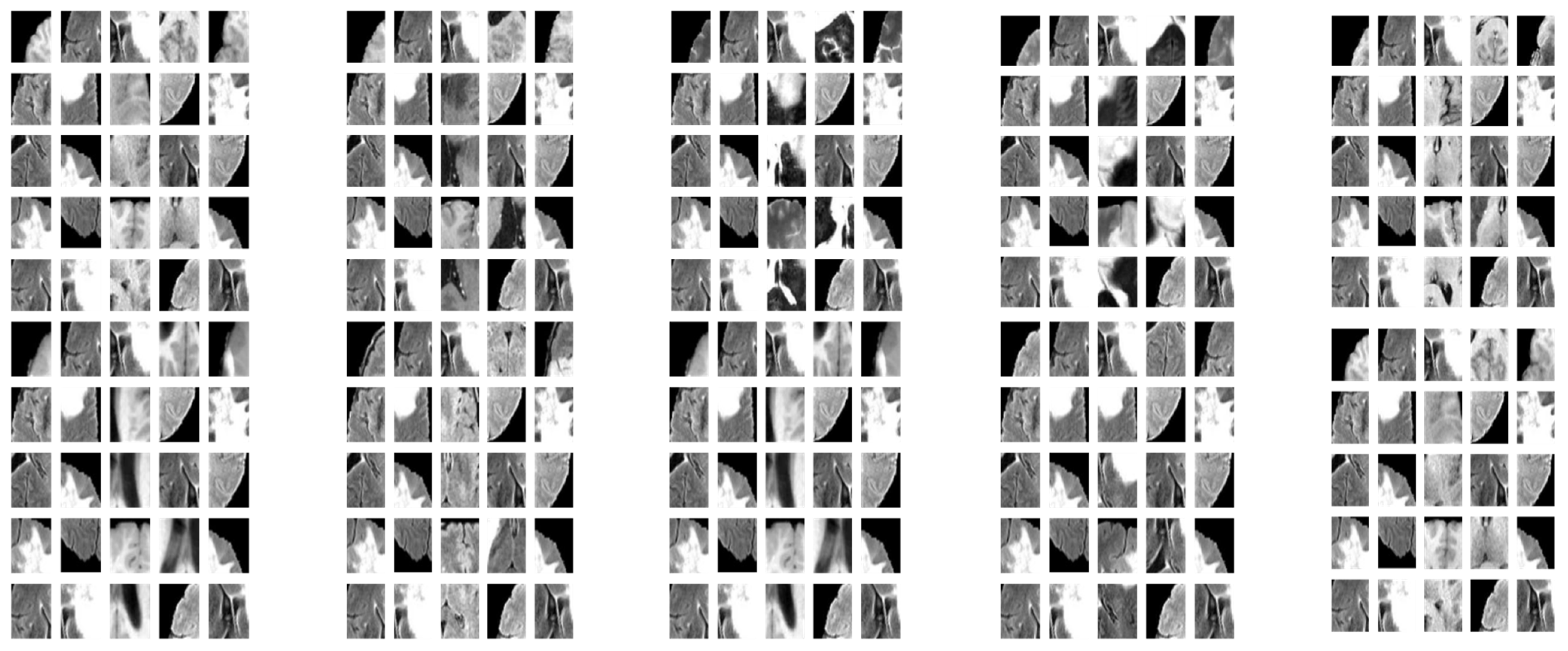 Brain Tumor Segmentation Using a Patch-Based Convolutional Neural Network: A Big Data Analysis ...