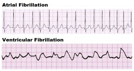 Prediction and Analysis of Heart Diseases Using Heterogeneous Computing ...