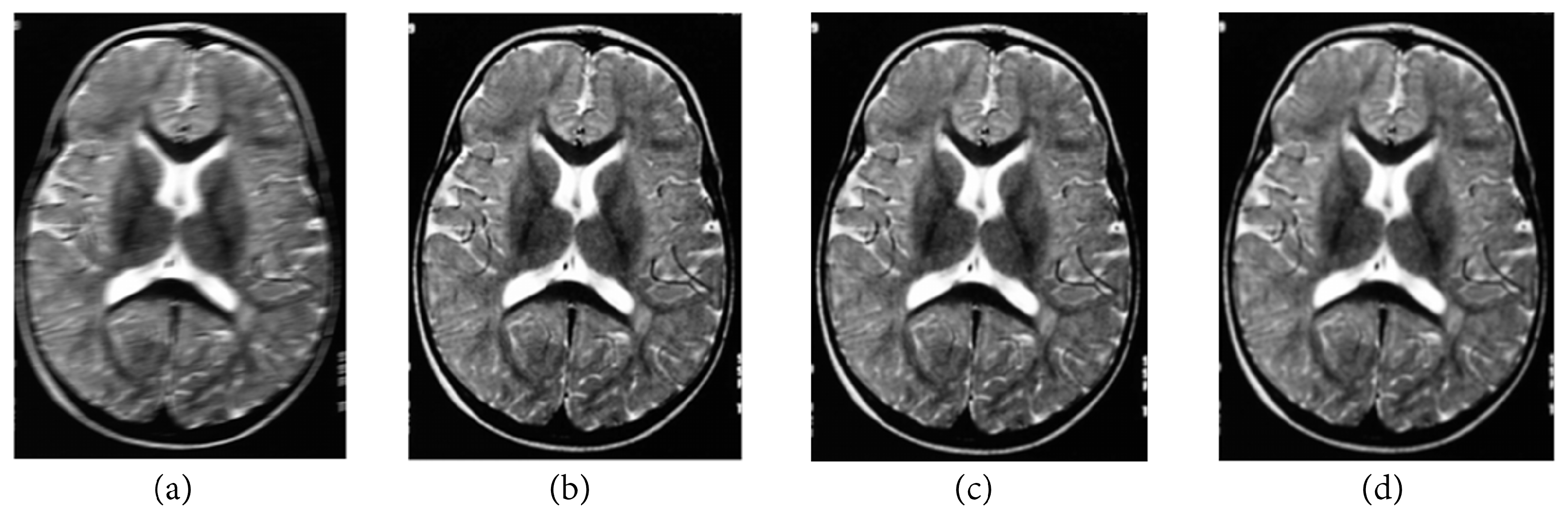 An Inertial Forward–Backward Splitting Method for Solving Modified Variational Inclusion ...