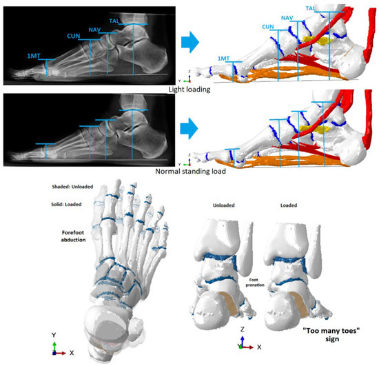 Mathematics | Free Full-Text | Biomechanical Effects of Medializing ...