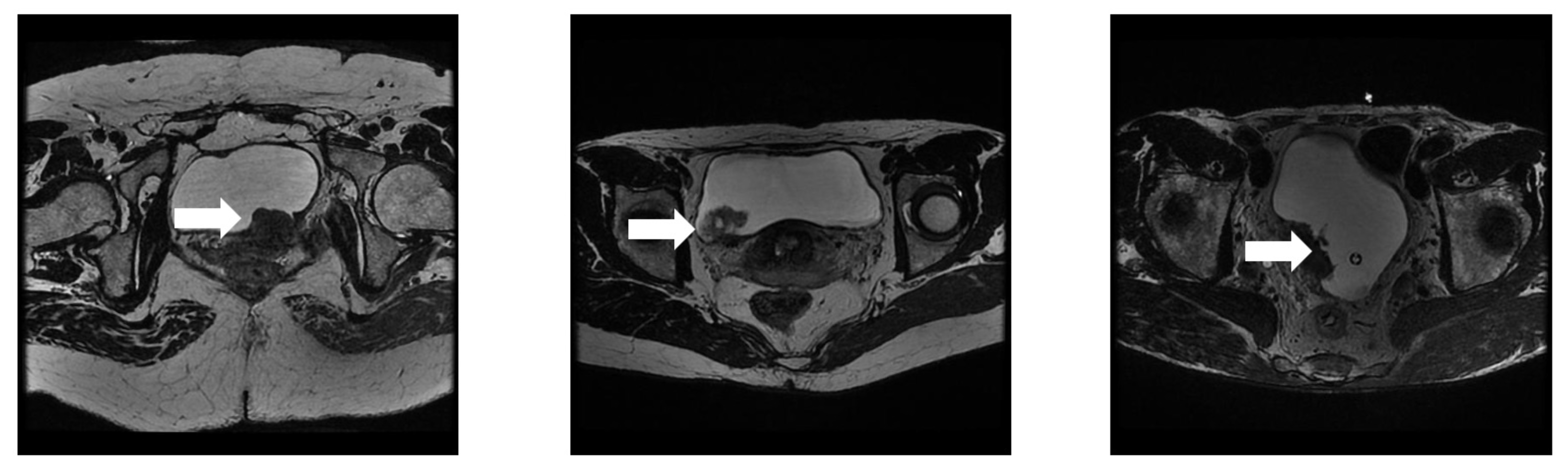 LCANet: A Lightweight Context-Aware Network for Bladder Tumor Segmentation in MRI Images