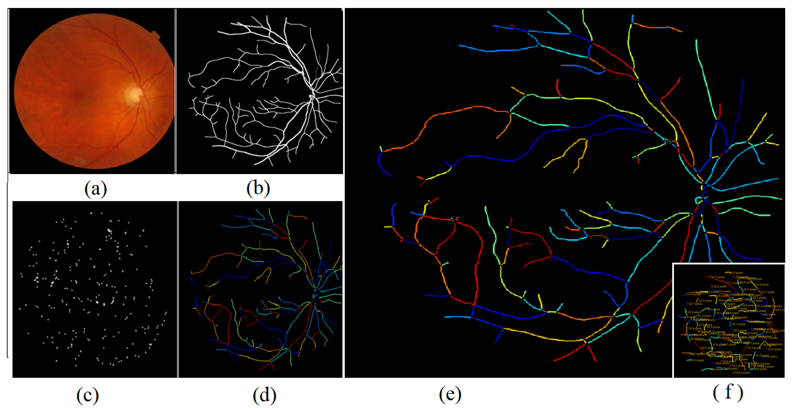 Mathematics | Free Full-Text | Enhancing Vessel Segment Extraction in Retinal Fundus Images ...