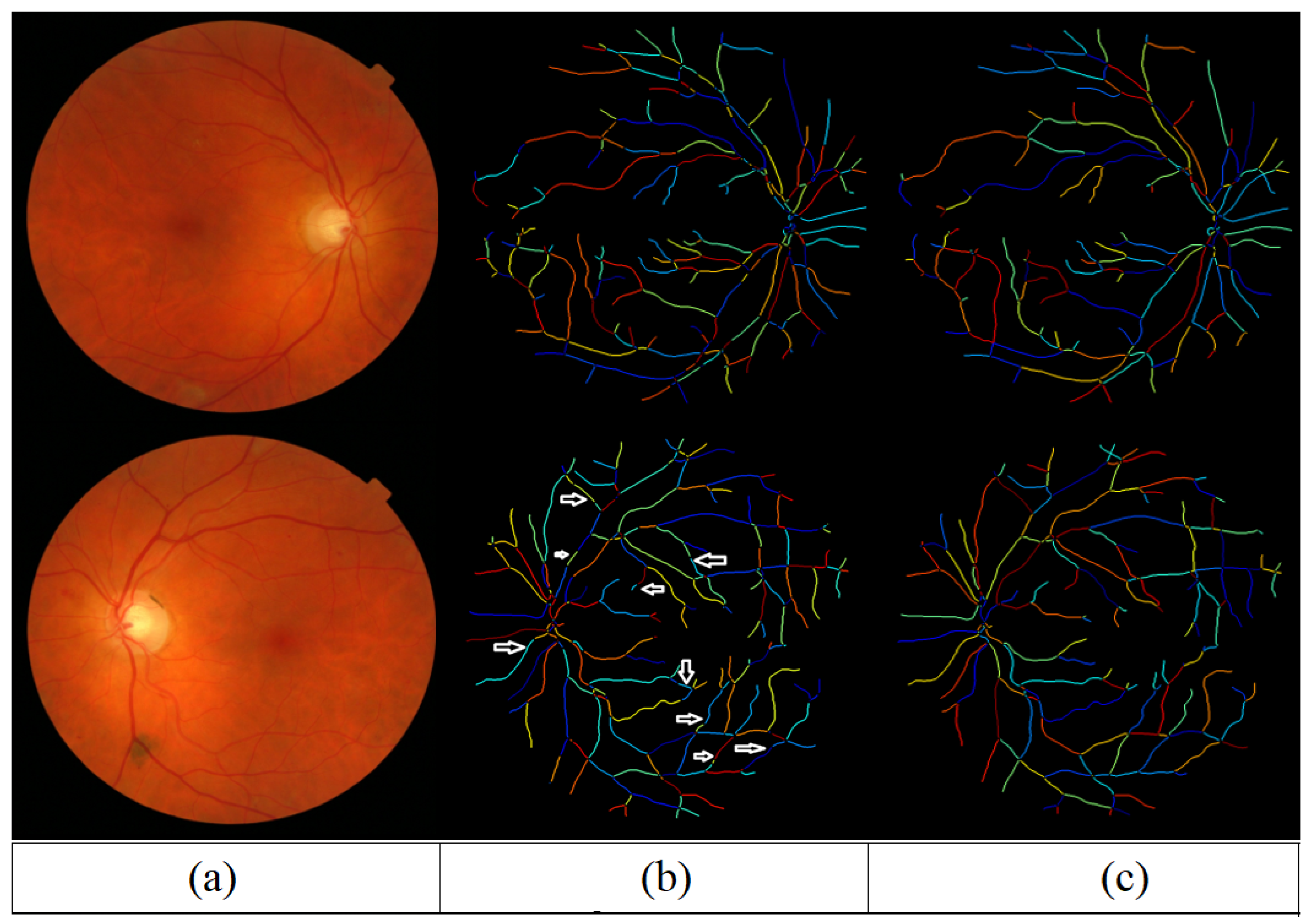 Mathematics | Free Full-Text | Enhancing Vessel Segment Extraction in ...
