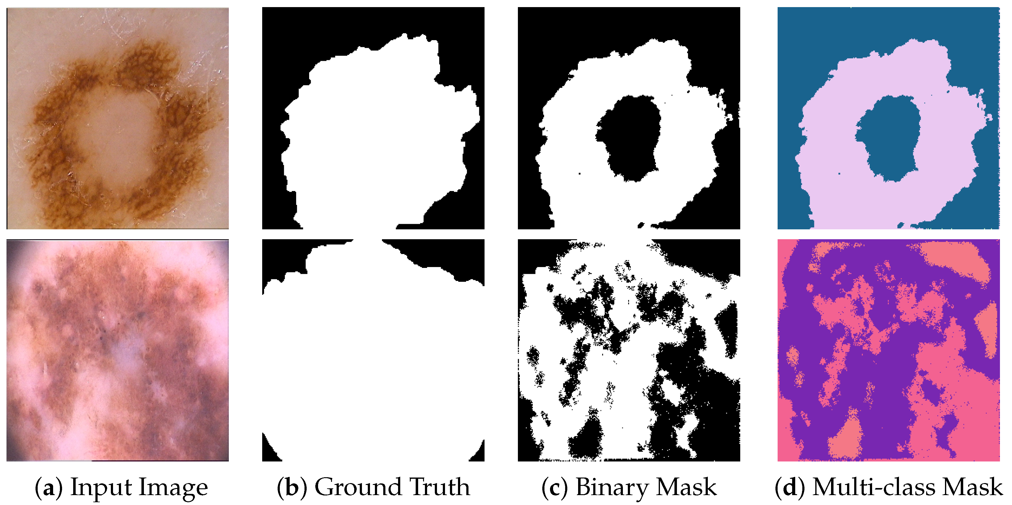 Self-Supervised Skin Lesion Segmentation: An Annotation-Free Approach