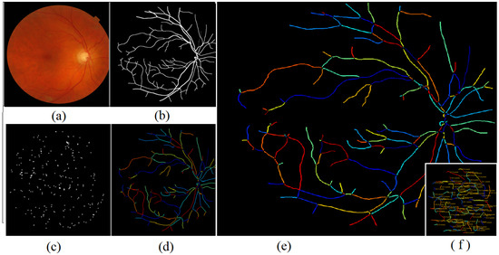 A Comparison of the Tortuosity Phenomenon in Retinal Arteries and Veins ...