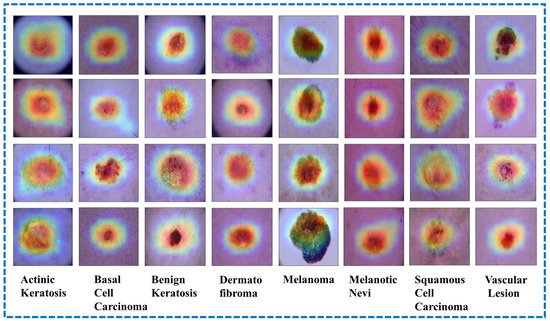 SNC_Net: Skin Cancer Detection by Integrating Handcrafted and Deep ...