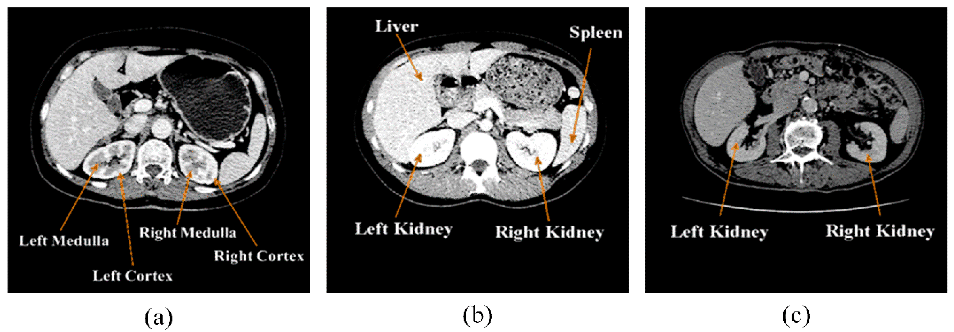 Mathematics | Free Full-Text | An Unsupervised Computed Tomography Kidney Segmentation with ...