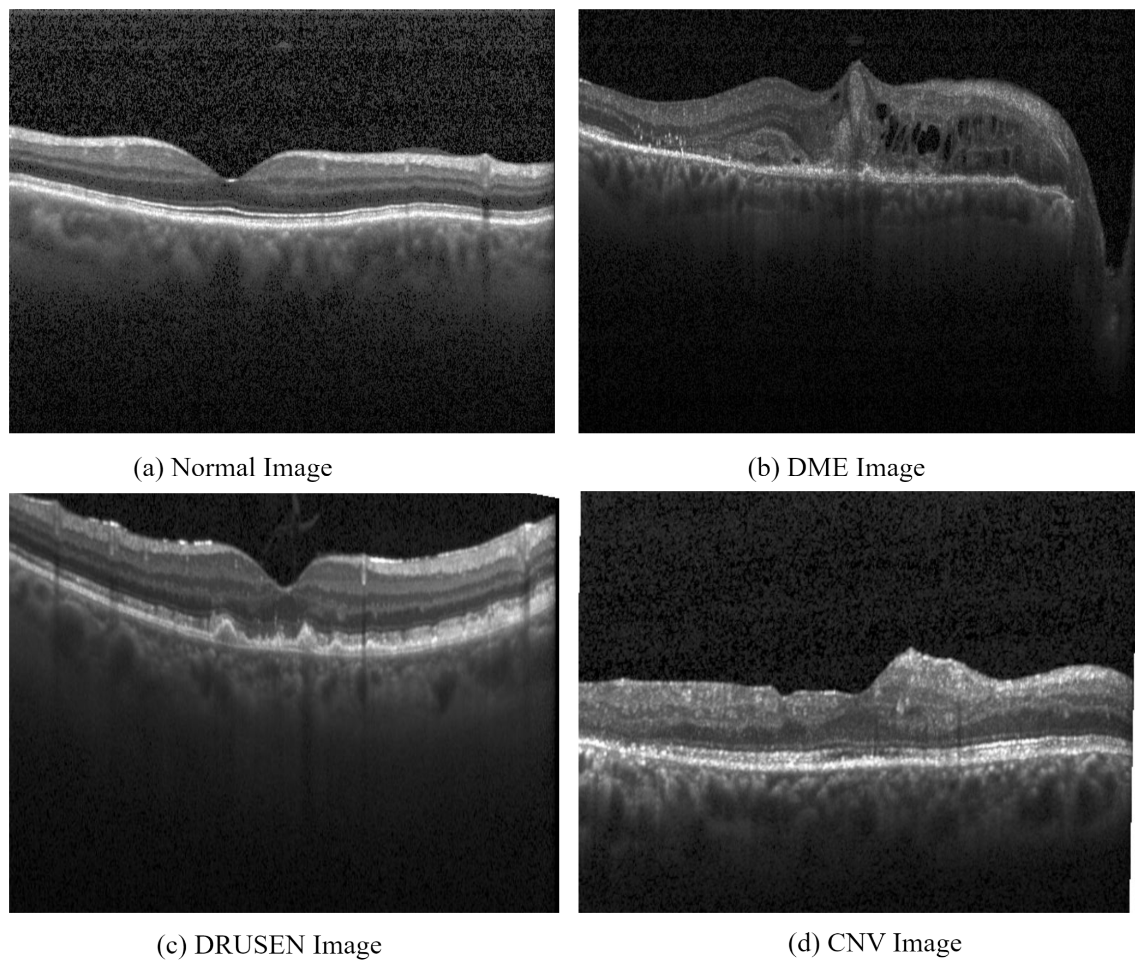OCTNet: A Modified Multi-Scale Attention Feature Fusion Network with ...
