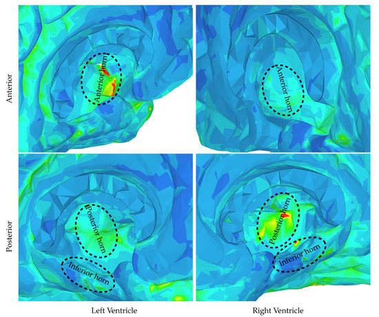 Mechanism of Coup and Contrecoup Injuries Induced by a Knock-Out Punch