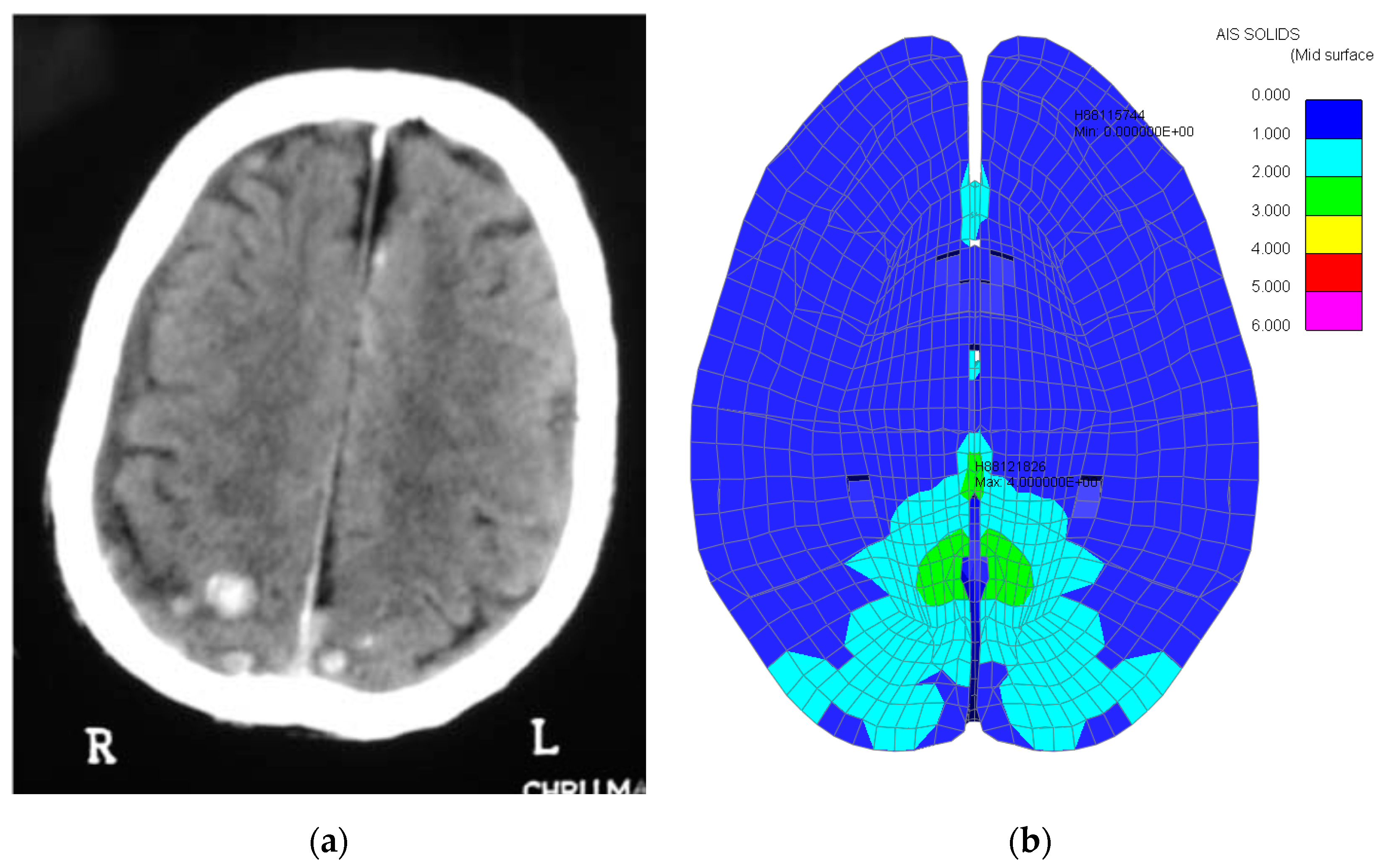 Computing Brain White and Grey Matter Injury Severity in a Traumatic Fall