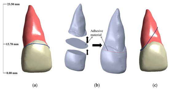 Effect of Adhesive Materials in Re-Attachment of Crown and Crown–Root ...