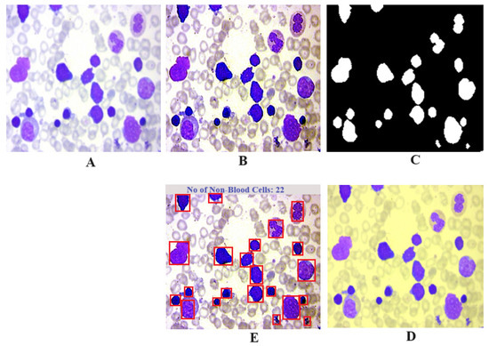 A Comprehensive Assessment and Classification of Acute Lymphocytic Leukemia