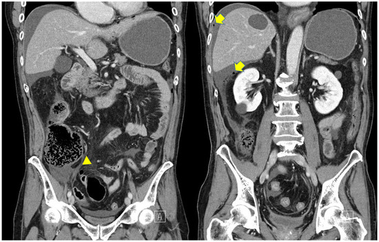 A Case of Isolated Cecal Necrosis Preoperatively Diagnosed with ...