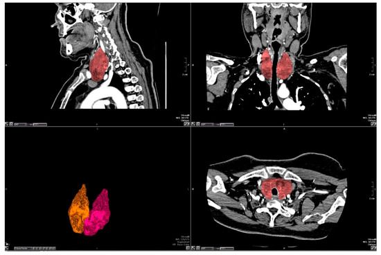 Determining the Thyroid Gland Volume Causing Tracheal Compression: A ...