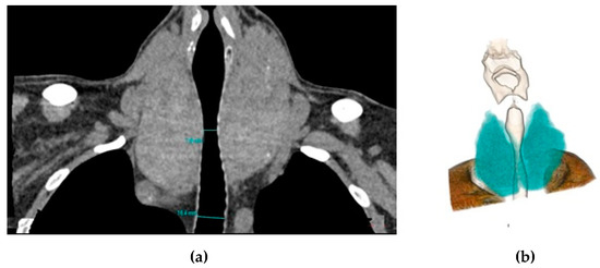 Determining the Thyroid Gland Volume Causing Tracheal Compression: A ...