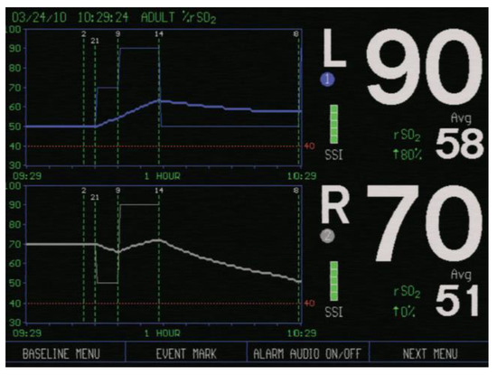 Near Infrared Spectroscopy Based Clinical Algorithm Applicability ...
