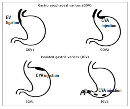 Current Approaches to the Treatment of Gastric Varices: Glue, Coil ...