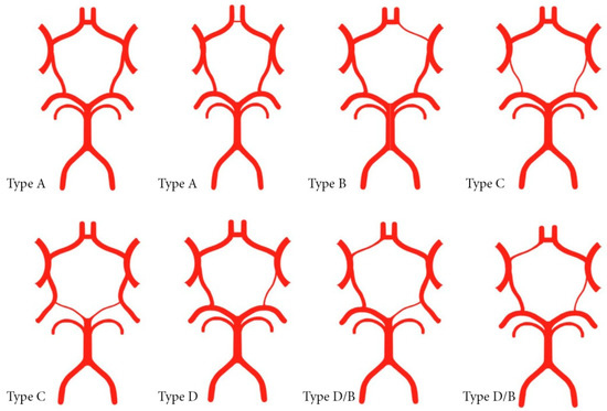 Association between Circle of Willis Configuration and Rupture of ...